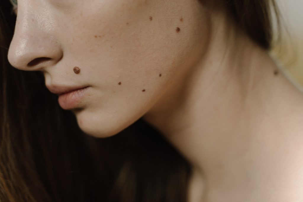 Opasni madeži: Kako ih prepoznati i kada morate posjetiti dermatologa? - N1