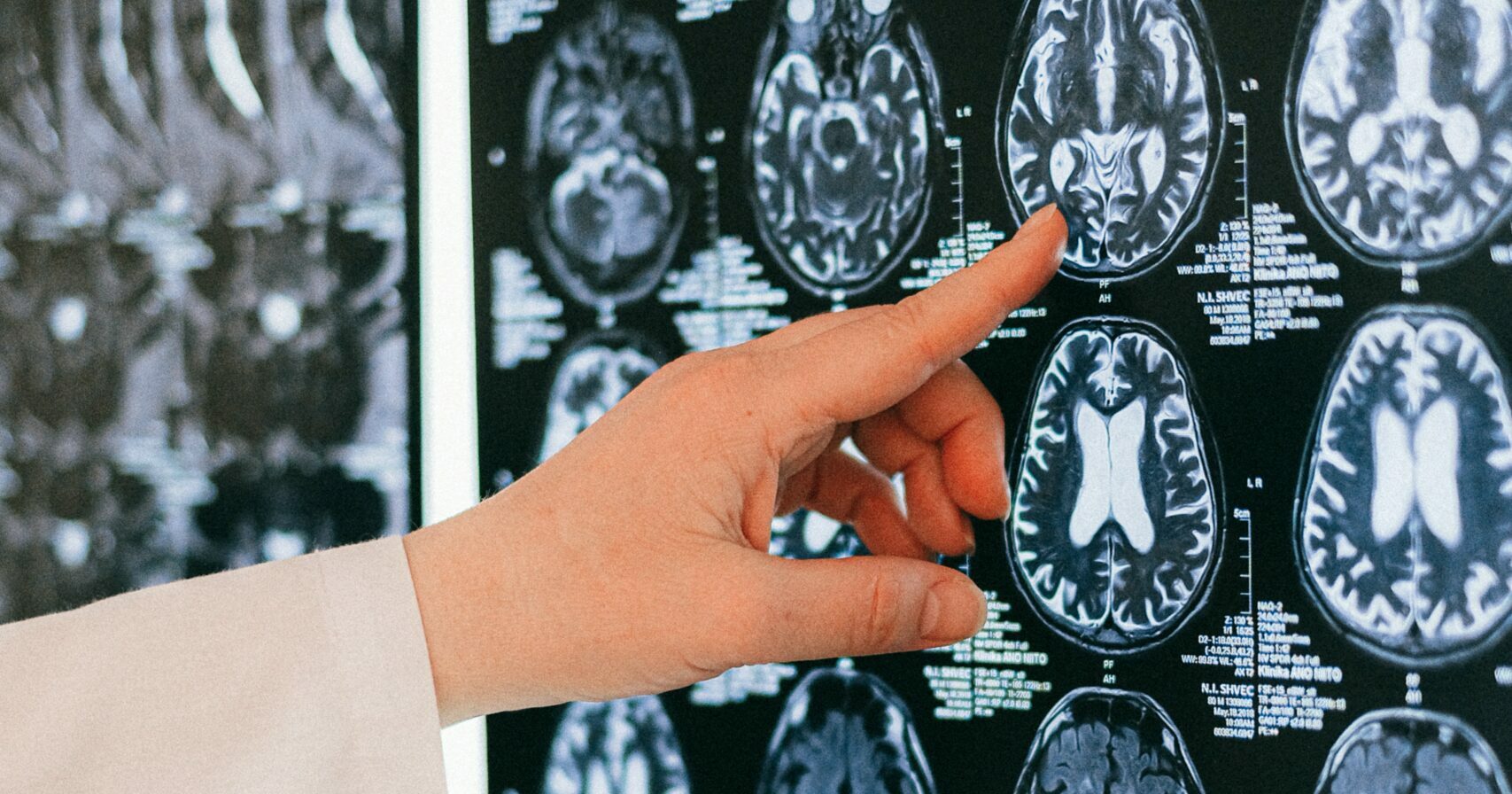 Multipla skleroza: Uzrok, simptomi i kako se liječi ova opasna ...