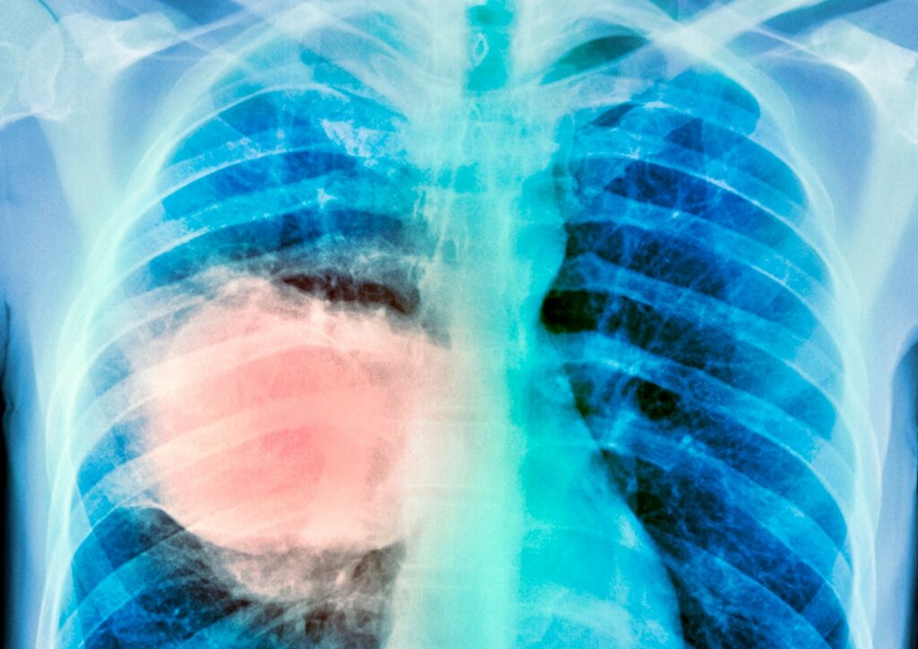 Rak pluća: Uzrok, simptomi i pravilno liječenje smrtonosne bolesti - N1